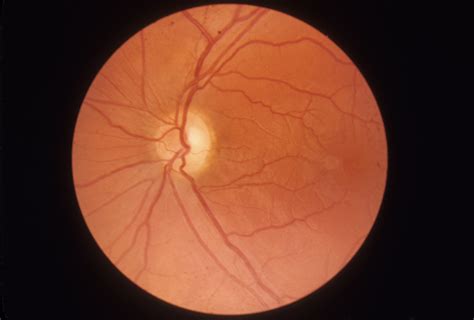 Leber Optic Atrophy Hereditary Ocular Diseases