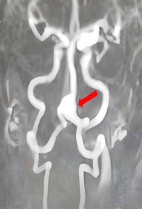 Cerebral Mri Angiogram Showing A Saccular Aneurysm Of The Basilar Trunk
