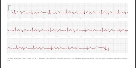 Is This Cause For Concern Wife Has Multiple Ecgs Like This Over The