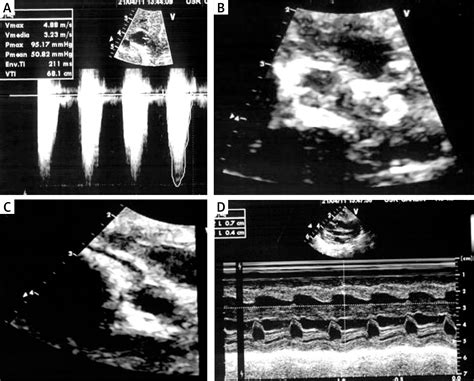 Generalized Arterial Calcifications In A Twin Recipient Treated With