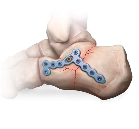 Arthrex Calcaneal Fracture System