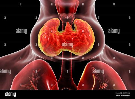 3d Illustration Of A Woman With An Enlarged Thyroid Gland Known As A