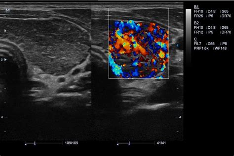 Hashimotos Thyroiditis The Strangesounding Condition