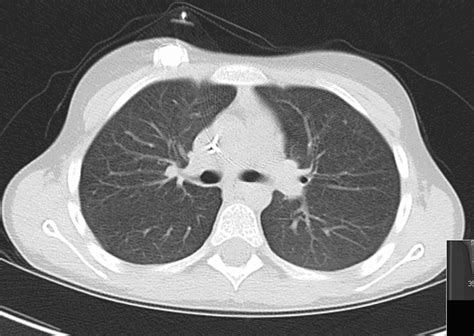 Good 2 Subjective Image Quality With Beam Hardening Artifact Of A Download Scientific Diagram