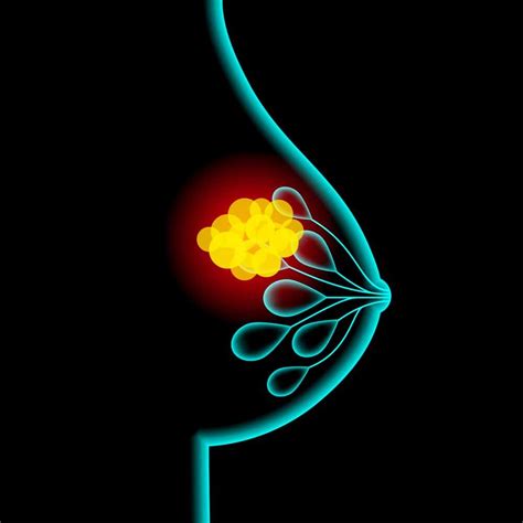 Invasive Breast Cancer Nccn Guidelines For Patients Breast Cancer