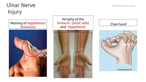 Radial And Ulnar Nerves Anatomy Course Description Ppt