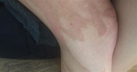 Margarita Dermatitis Album On Imgur