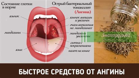 Как избавиться от боли в горле за пару часов Знахарушка все о здоровье