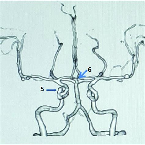 Case 1 Aneurysms With Their Sizes 6 Left M1 Aneurysm 3 Mm 7 Right