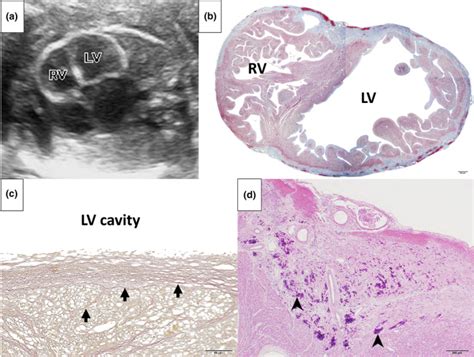 A Case Of Fetal Myocardial Calcification With Hyperechoic Area In Fetal Echocardiography Pmc