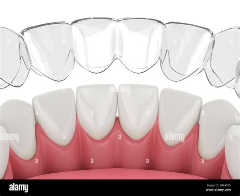 3d Render Of Invisalign Removable And Invisible Retainer With Lower Jaw Over White Background