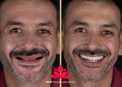 Zirconia Crowns Before And After Transform Your Smile Procedure Nsw Dental Lab
