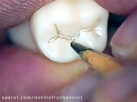 آماده سازی دندان مولر پایین جهت ترمیم کلاس 1