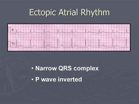 Basics Of Ekg Interpretation презентация онлайн