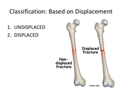 Classification Of Fractures And Compound Fracture Managment