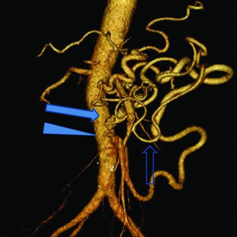 Postoperative Ct Angiogram Showing An Aorta Sma Bypass Arrow New