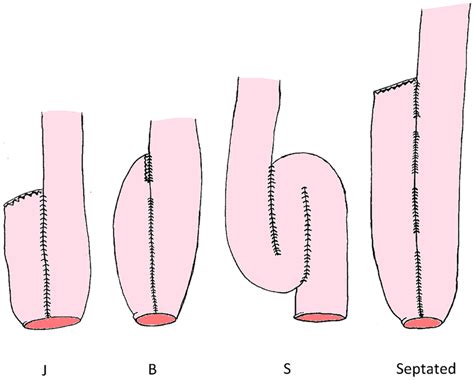 Schematic Overview Of Pouch Designs A J Pouch B B Pouch C