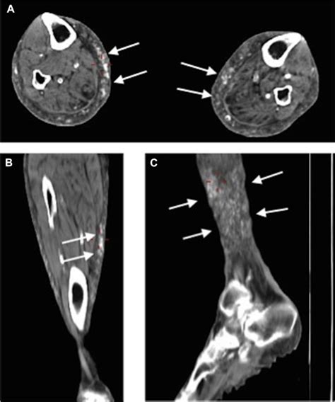 Calciphylaxis On Bone Scan Correlation Between Molecular And Cross Sectional Findings Pmc