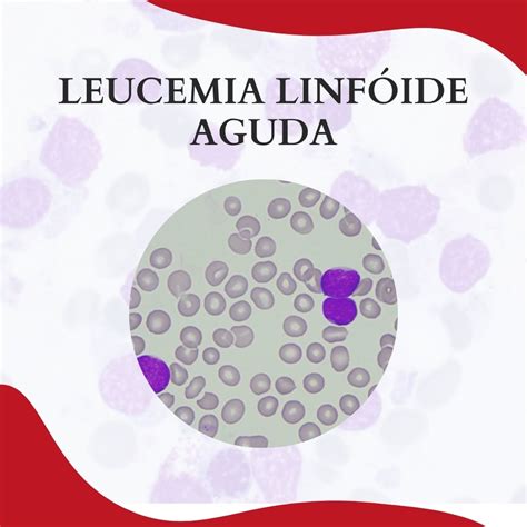 Medula Ossea Leucemia Linfoblastica Aguda
