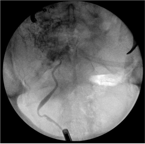 Retrograde Pyelogram Demonstrating Ureteral Injury Download Scientific Diagram