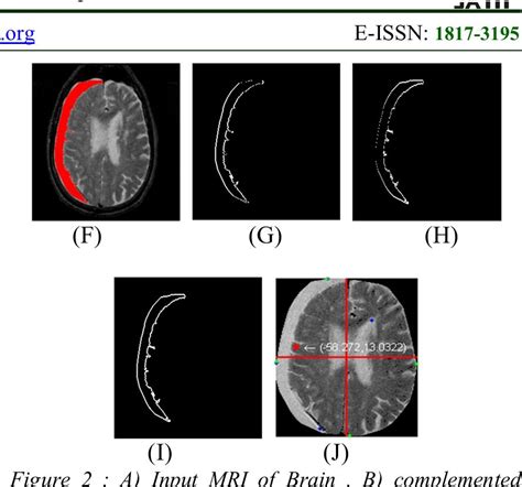 Figure 3 Automated Brain Hemorrhage Lesion Segmentation