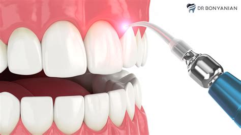 افزایش طول تاج دندان مزایا، عوارض و عکس قبل و بعد جراحی