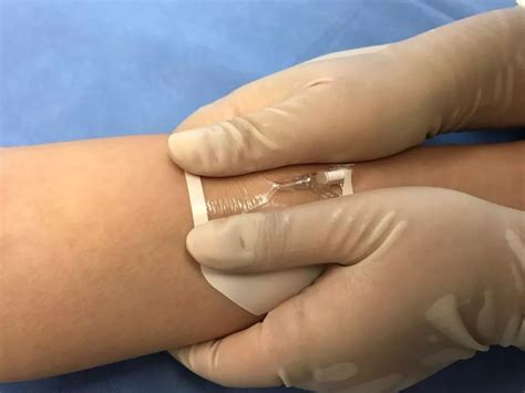 固定前臂y型留置针流程分步走敷料