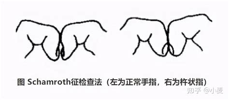 麦迪森健康提醒：手指末端莫名肿大！当心是疾病信号！ 知乎