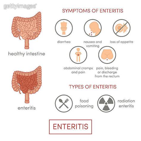 Symptomps Of Enteritis 이미지 499541478 게티이미지뱅크