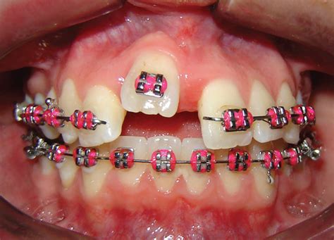 Intrabuccal Photographs And Periapical Radiograph Before Surgery Download Scientific Diagram