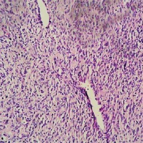 Pdf Soft Tissue Fibrosarcoma Neck Mimicking As Thyroid Swelling