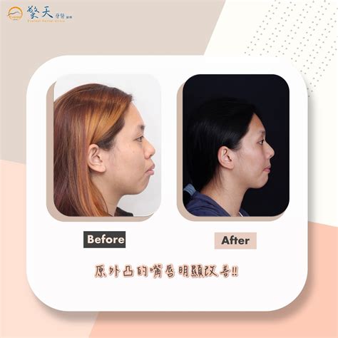 擎天牙醫診所 隱適美案例1206