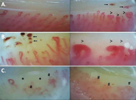 Capillaroscopic Patterns Of Microangiopathy In Systemic Sclerosis A