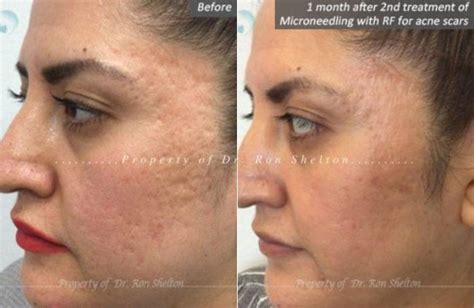 Microneedling With Rf Before And After Photos Ron Shelton Md