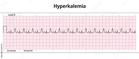 Ecg Hyperkalemia Hyperkalaemia 8 Second Ecg Paper Electrocardiogram Vector Medical