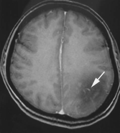 The Mri Appearance Of Tumefactive Demyelinating Lesions Ajr