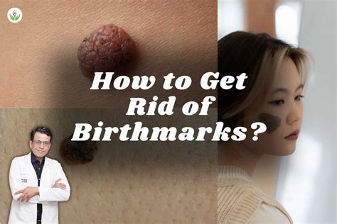 How To Get Rid Of Birthmarks Care Well Medical Centre
