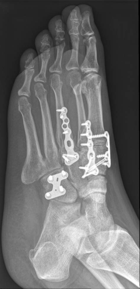 Cuboid Bone Nutcracker Fracture At Wendy Hopkins Blog