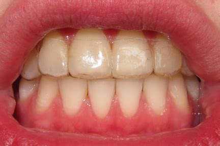 Say Braces Before And After Braces—braces Off Underbite Fixed And