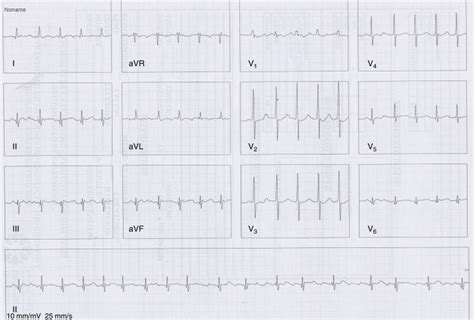 Electrocardiograma Con Flutter Auricular No Común Download