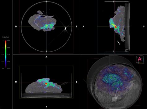 Imaging Case 14 Breast Cancer Ductal Carcinoma In Situ