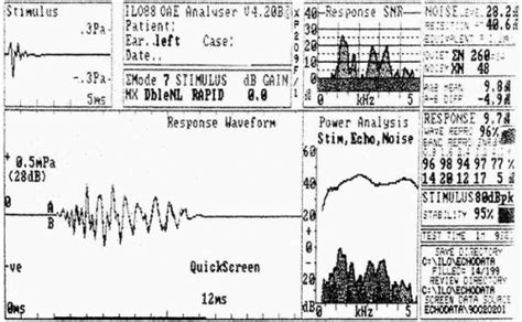 Audiologic Tests For Otologic Surgery Ento Key