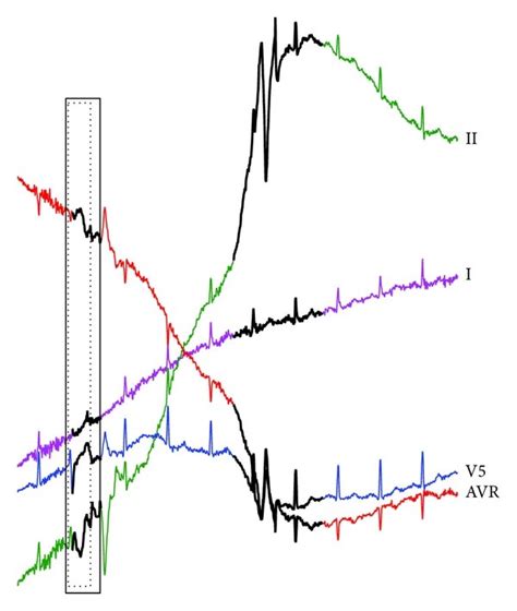 Anomaly Detection Results For The Incartdb05 Dataset By Raad Algorithm Download Scientific