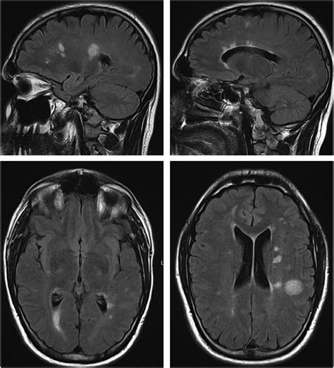 Multiple Sclerosis Part 1 Magnetic Resonance Imaging Clinics