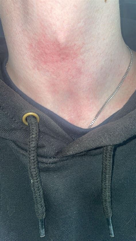 Does This Look Like An Hiv Rash Rhiv