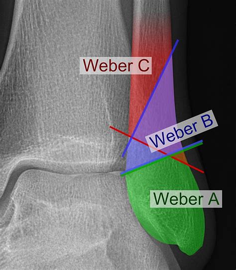 Danis Weber Classification On X Ray Danis Weber Classification Wikipedia Ankle Fracture