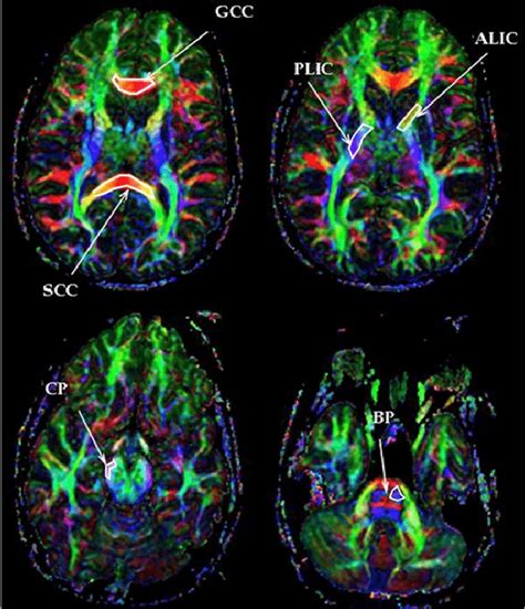 diffusion encoded color maps show the six selected white matter