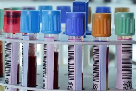 D Dimer Yükselince Ne Olur Güncel Oku