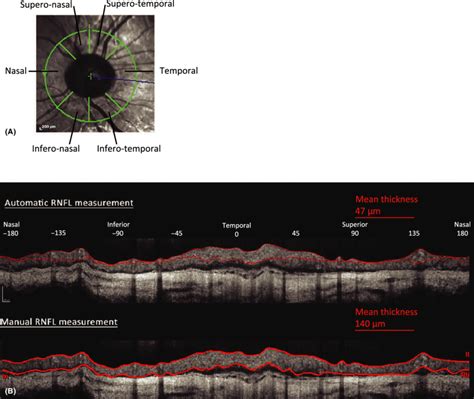 Measurement Of Peripapillary Retinal Nerve Fibre Layer Rnfl Thickness Download Scientific
