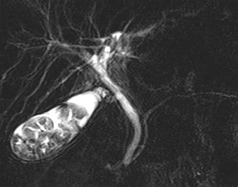 A Case Of Biliary Intraepithelial Neoplasm In A Young Man Diagnosed By Laparoscopic Hepatectomy